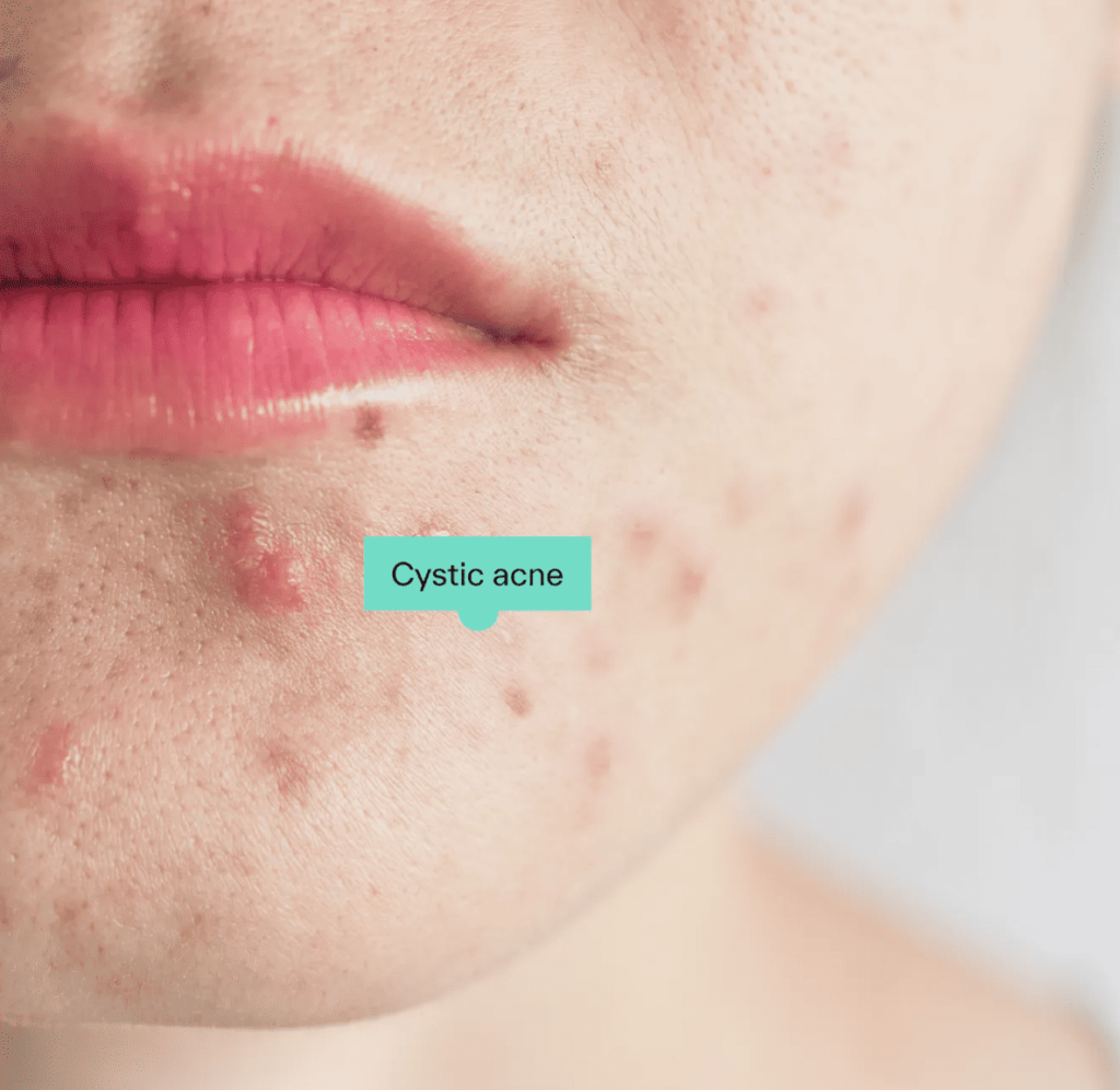 Acne – The Holistic Health Centre
