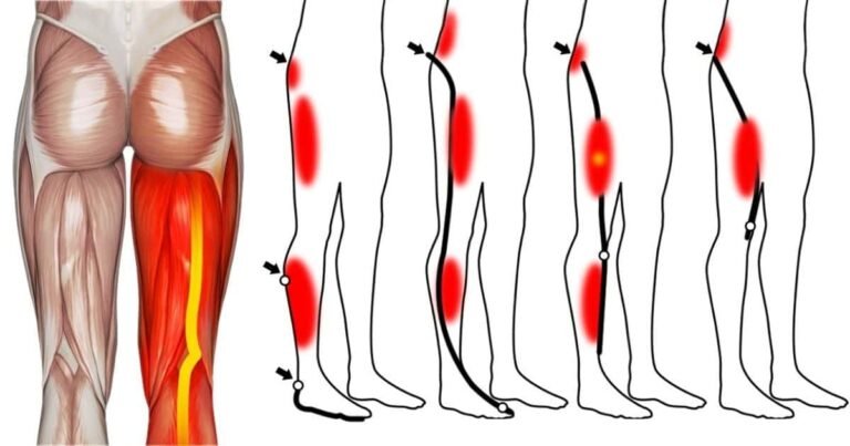 Sciatica: Understanding When that Pain Down Your Leg is and is NOT ...